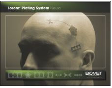 zimmer biomet Plating system - Ortomedic